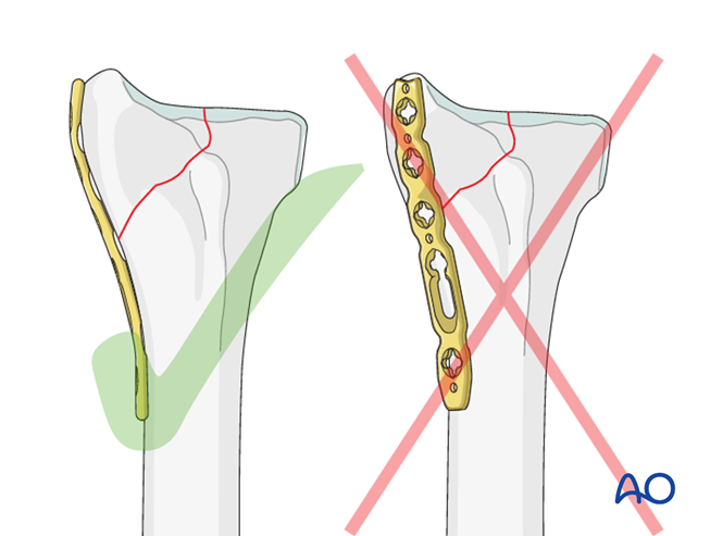 ORIF - Radial column plate for Partial articular, sagittal simple ...