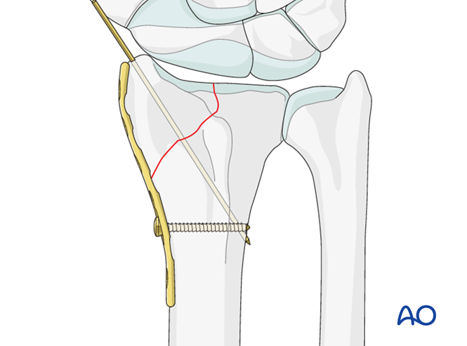 ORIF - Radial column plate for Partial articular, sagittal simple ...