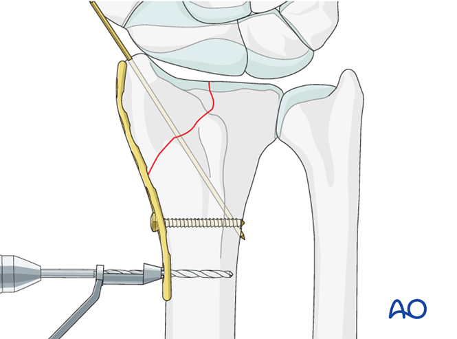 ORIF - Radial column plate for Partial articular, sagittal simple ...