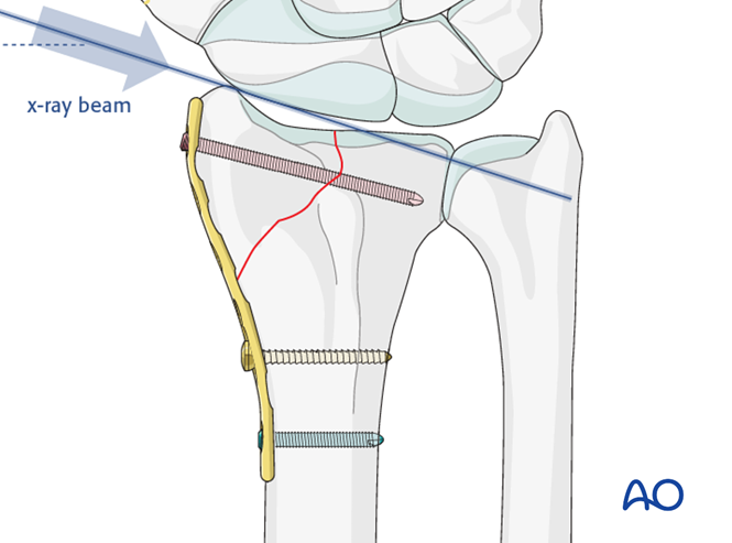 ORIF - Radial column plate for Partial articular, sagittal simple ...