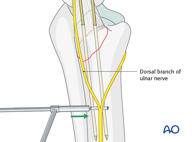 ORIF - Tension band wire for Extraarticular fracture of the ulnar ...