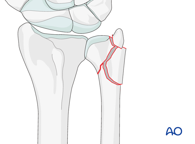 ORIF - Hook plate for Extraarticular multifragmentary fracture of the ulna