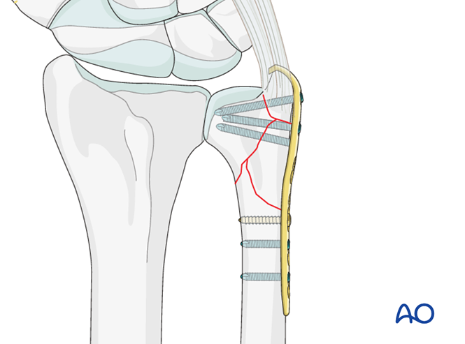 ORIF - Hook plate for Extraarticular multifragmentary fracture of the ulna