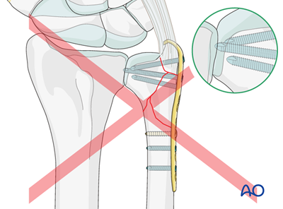 ORIF - Hook plate for Extraarticular multifragmentary fracture of the ulna