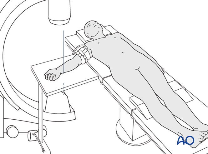 ORIF - Lag screw for Extraarticular fracture of the ulnar styloid process