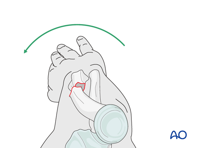 Supine (dorsal approach)