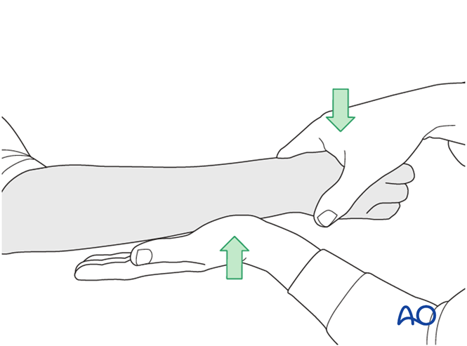 Segmental ulnar fracture: compression plating