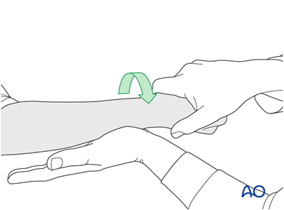 DRUJ stabilization (Galeazzi fracture-dislocation)