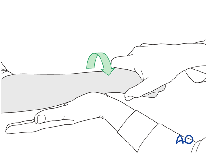 DRUJ stabilization (Galeazzi fracture-dislocation)