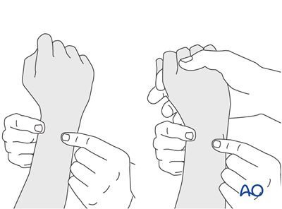 DRUJ stabilization (Galeazzi fracture-dislocation)