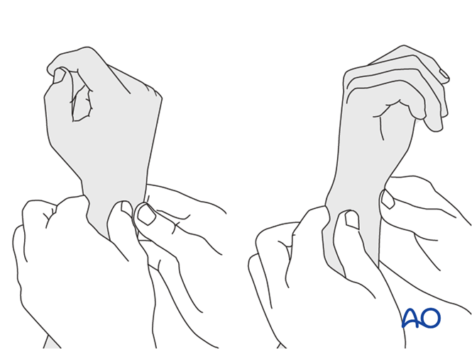 ORIF - Compression Plating for Simple fracture of the radius and the ulna