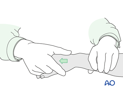 Closed reduction - Lag screws for Partial articular, sagittal simple ...