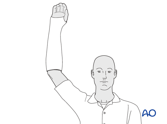 Nonoperative treatment - Cast for Extraarticular fracture of the radius ...