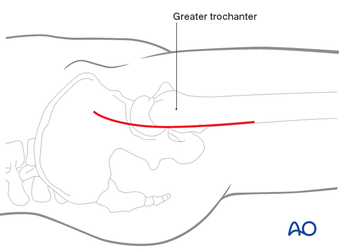Anterolateral approach (Watson-Jones) to the proximal femur