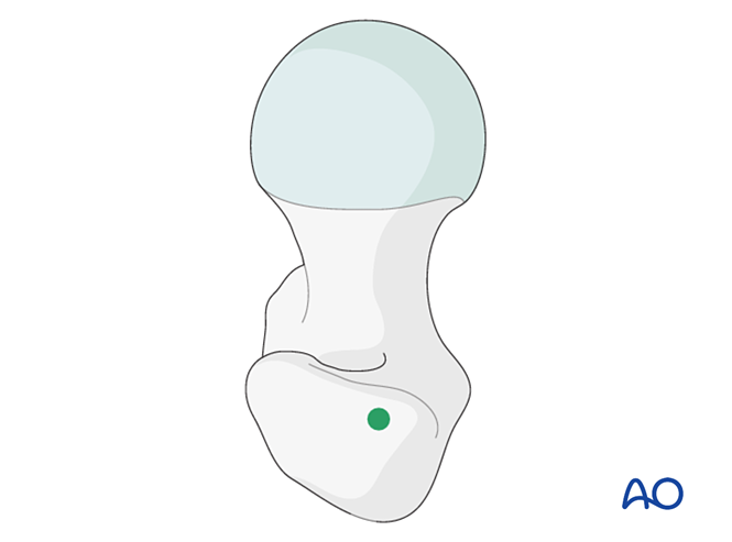 Approach for proximal femoral nailing