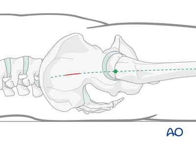 Approach for proximal femoral nailing