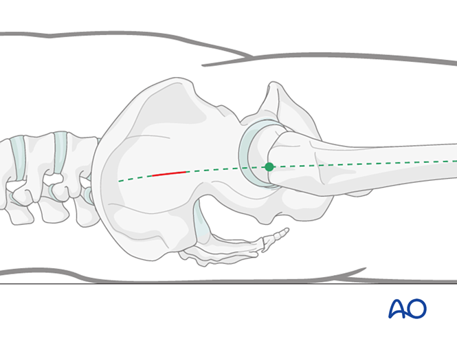 Nailing (short nail) for Intertrochanteric fractures