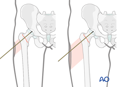 Limited lateral approach for implant insertion in the proximal femur