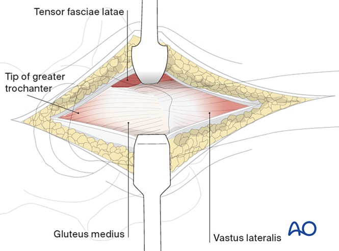 Limited lateral approach for implant insertion in the proximal femur