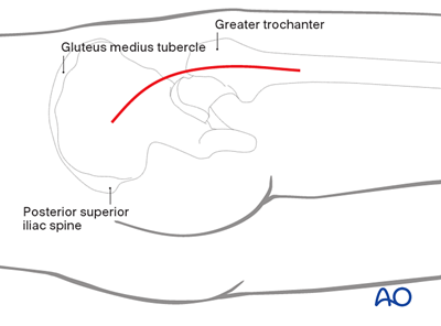Posterolateral (posterior) approach to the hip