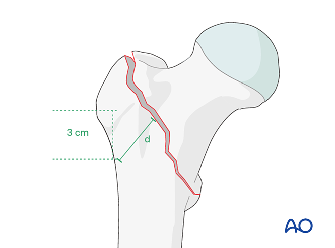 Simple two-part pertrochanteric fractures