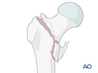 Simple pertrochanteric fractures with posteromedial involvement