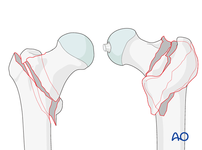 Multifragmentary pertrochanteric fractures with incompetent lateral wall