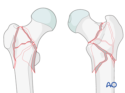 Intertrochanteric fractures