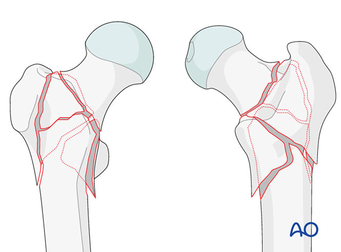 Intertrochanteric fractures