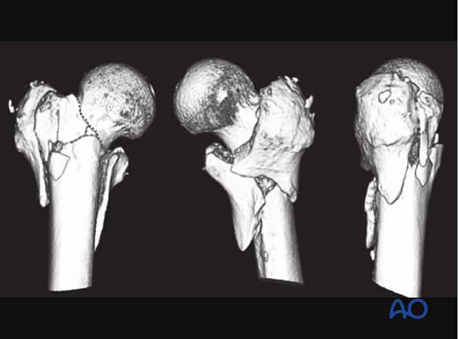 Intertrochanteric fractures