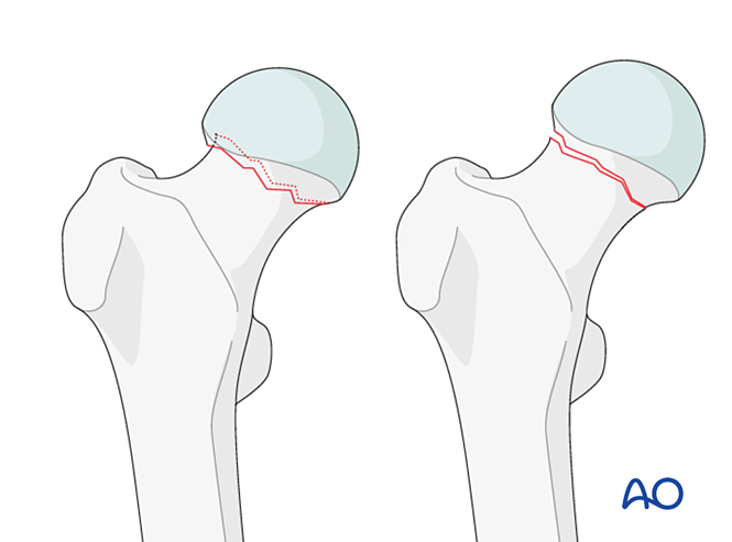 Impacted or nondisplaced subcapital femoral neck fractures