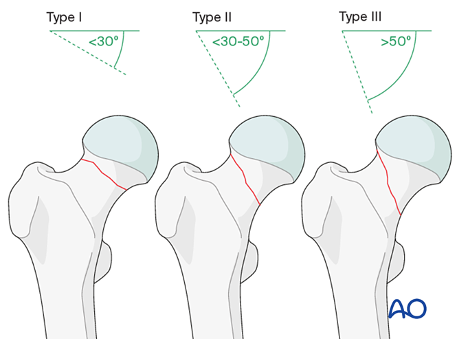 Transcervical femoral neck fractures (simple or multifragmentary)