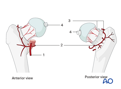Displaced subcapital femoral neck fractures