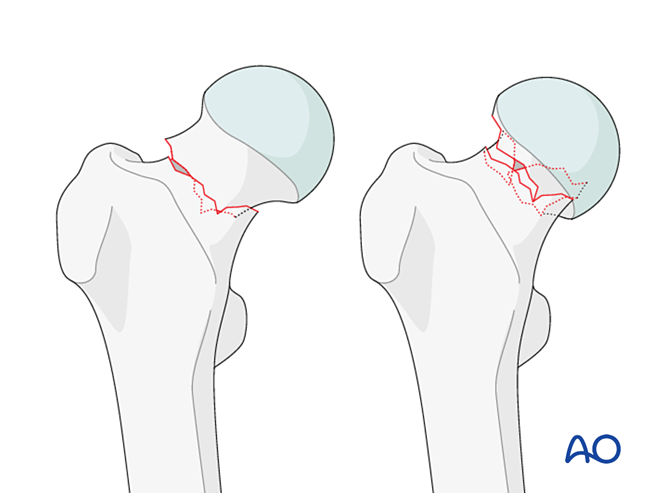 Transcervical femoral neck fractures (simple or multifragmentary)