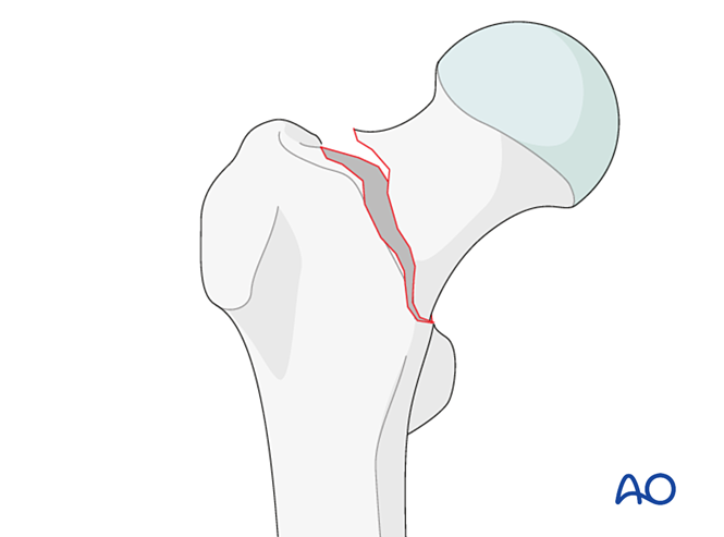Basicervical femoral neck fractures