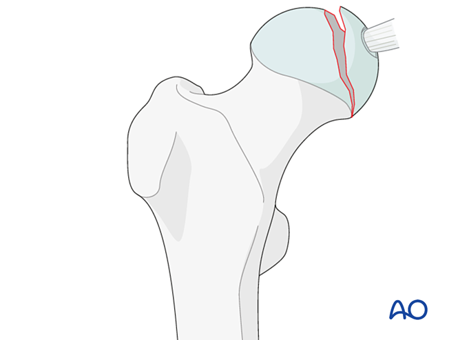 Split fractures of the femoral head