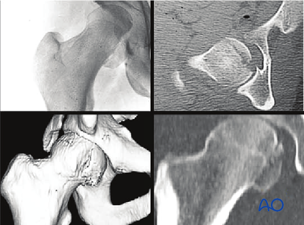 Femoral Head Fractures With Posterior Wall Fracture Of The Acetabulum