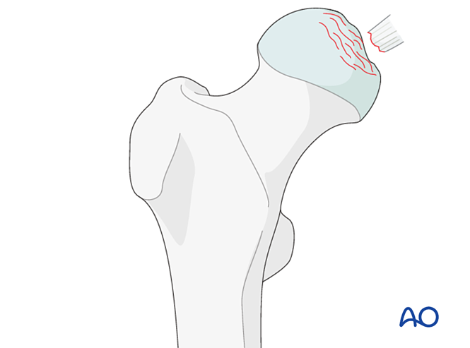 Depression fractures of the femoral head