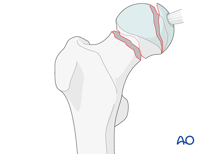 Femoral neck and head fractures with hip dislocation