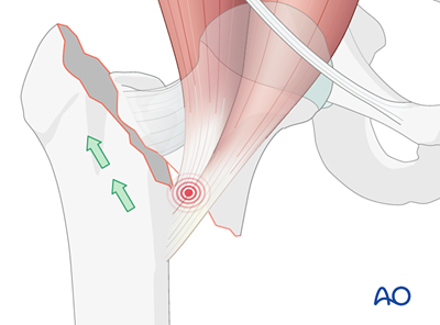 Simple two-part pertrochanteric fractures