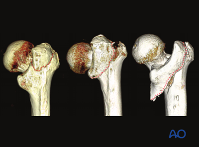 Multifragmentary pertrochanteric fractures with incompetent lateral wall