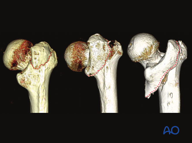 Multifragmentary pertrochanteric fractures with incompetent lateral wall