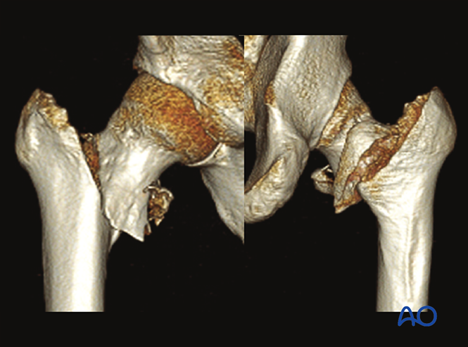 Simple pertrochanteric fractures with posteromedial involvement