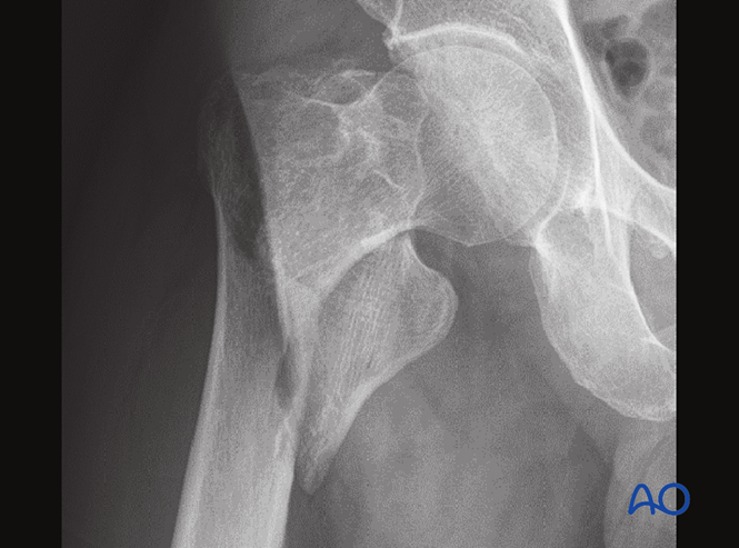 Multifragmentary pertrochanteric fractures with incompetent lateral wall