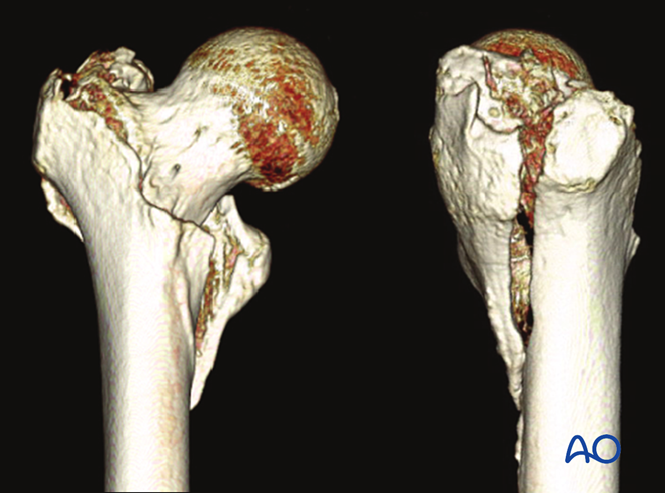 Multifragmentary pertrochanteric fractures with incompetent lateral wall