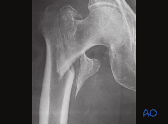 Multifragmentary pertrochanteric fractures with incompetent lateral wall