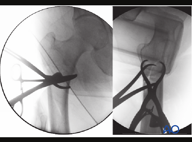 Nailing (short nail) for Intertrochanteric fractures
