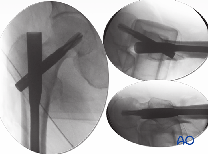 Nailing (short nail) for Intertrochanteric fractures