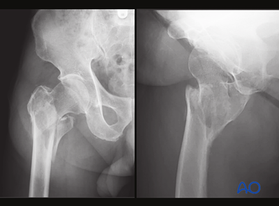 Intertrochanteric fractures