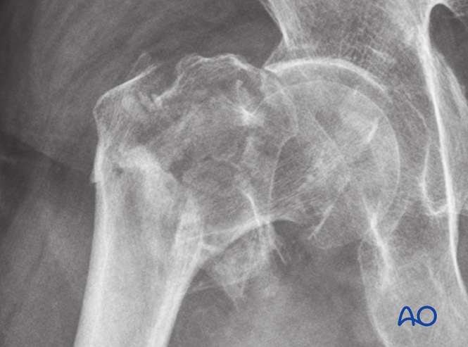 Intertrochanteric fractures